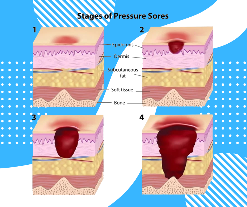 Elderly Pressure Sores Prevention And Treatment SR Parents Elderly Pressure Sores Prevention And Treatment SR Parents