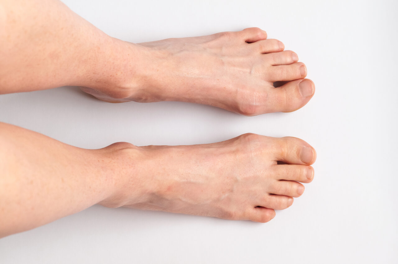 Foot Problems in Elderly People - SR Parents