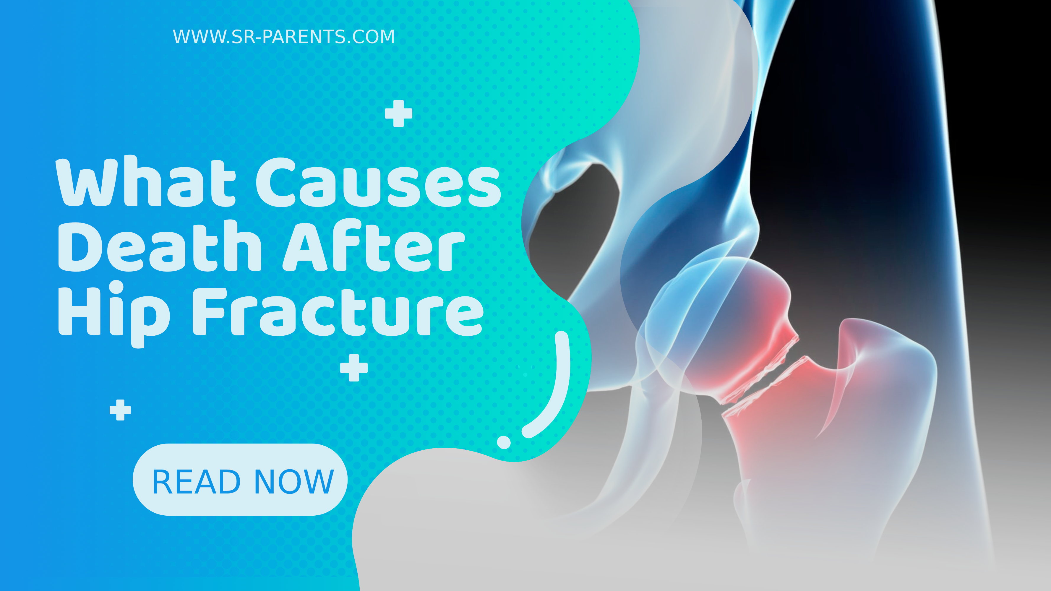 What Causes Death after Hip Fracture (3) - SR Parents